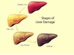 Chronic Liver Parenchymal Disease: Etiology, Symptoms, Treatment, and ...