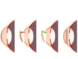 What is Corneal Transplant Surgery? Everything You Need to Know About ...